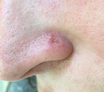 Basaliom Heidelberg | Basalzellkarzinom Diagnose und Behandlung